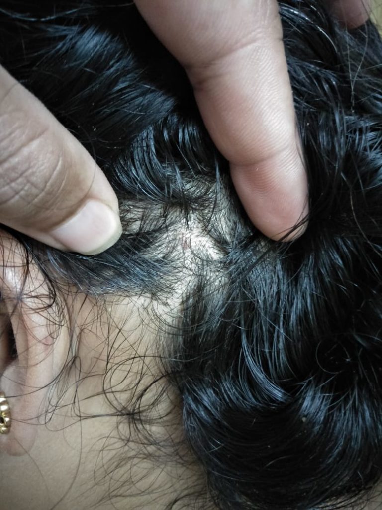 PYOGENIC GRANULOMA Cured with HOMEOPATHIC MEDICINES